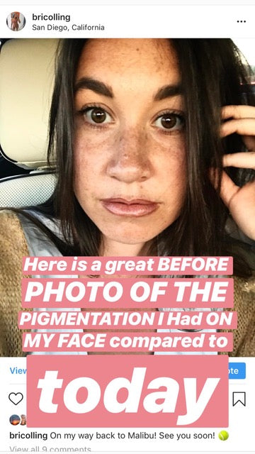 Bri Colling Offers Before & After Pics - See the Skin Resource.MD Diff ...